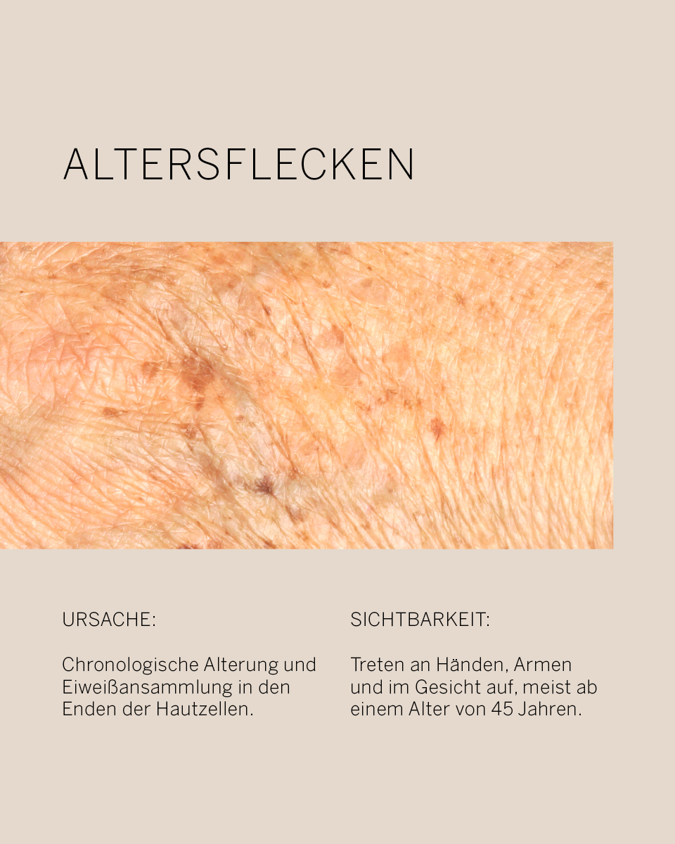 Hyperpigmentierung – Alles über Pigmentflecken und wie Du sie loswirst │ mit BABOR