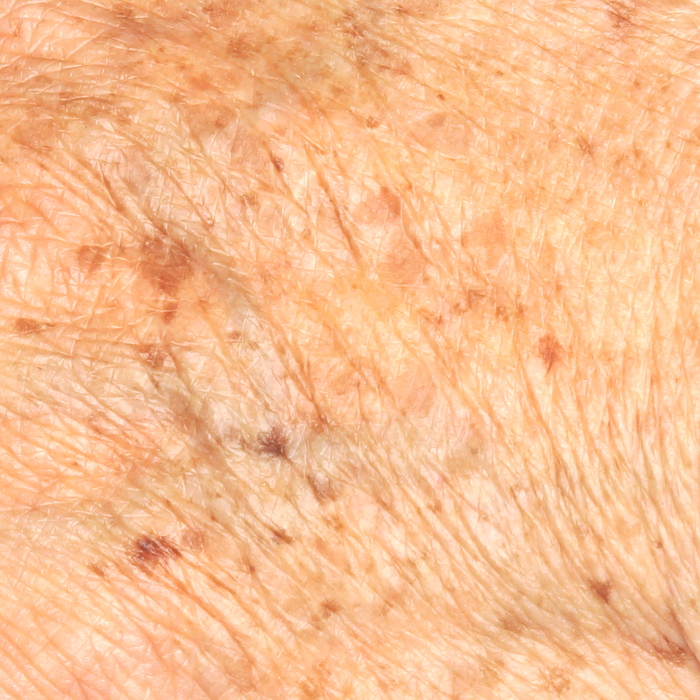 Hyperpigmentierung – Alles über Pigmentflecken und wie Du sie loswirst │ mit BABOR